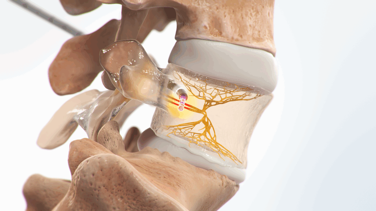 Vertebrogenic pain - California Pain Doctors